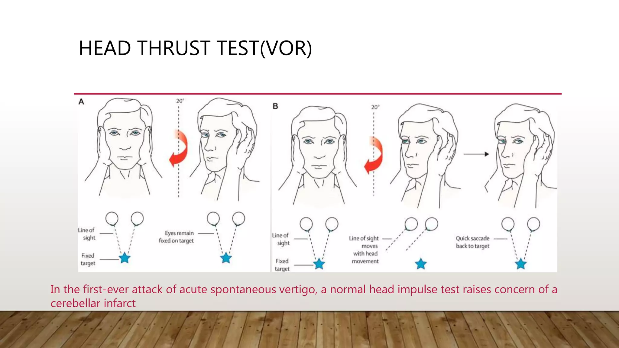 Approach to Vertigo | PPTX