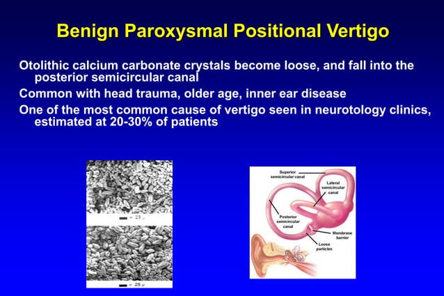 Vertigo & Dizziness: Diagnosis, Management | PPT | Ear, Nose and Throat ...