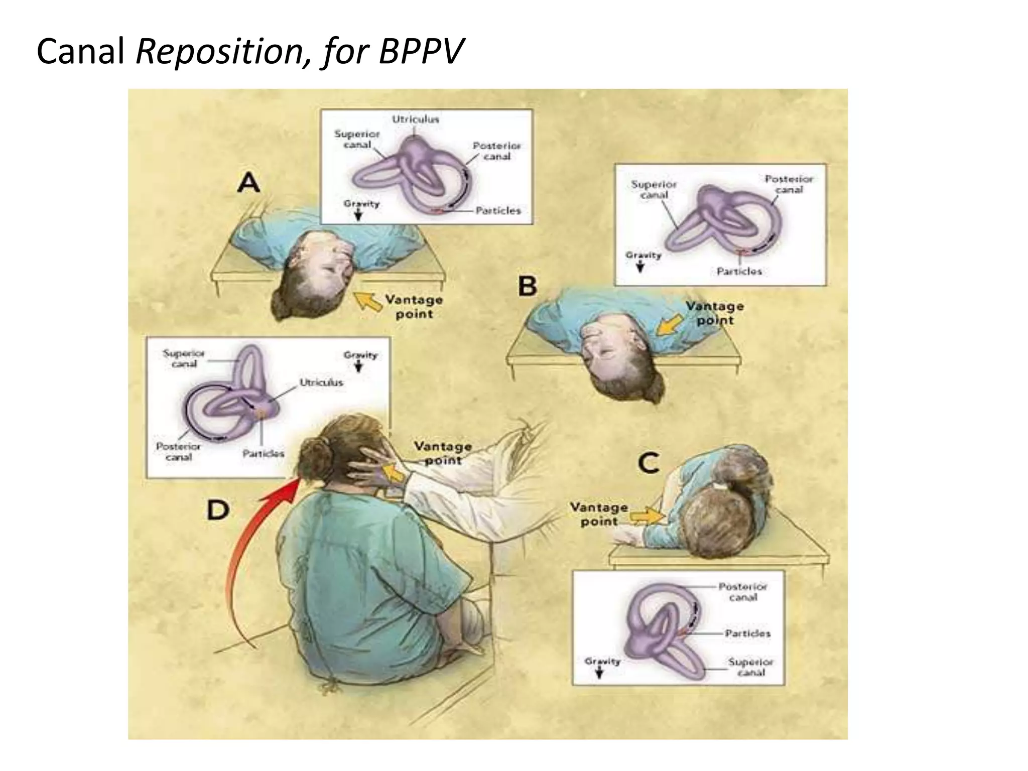 Vertigo Work up & management pptx.pptx