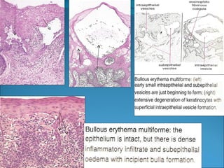 vesiculo bullous lesions | PPT