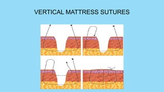 very very Basic Principles of Sutures , Wound management.pptx