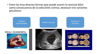 Vía biliar, Vesícula y apendicitis | PPTX