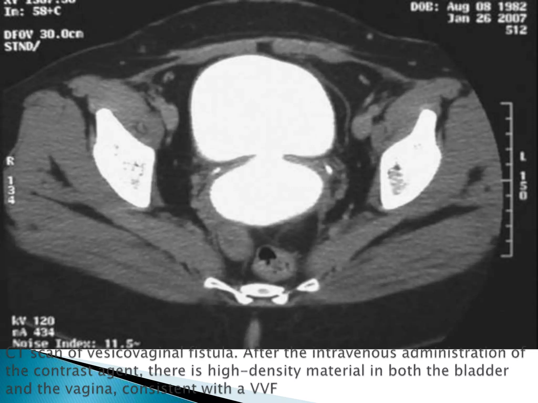 Vesico vaginal fistula | PPTX