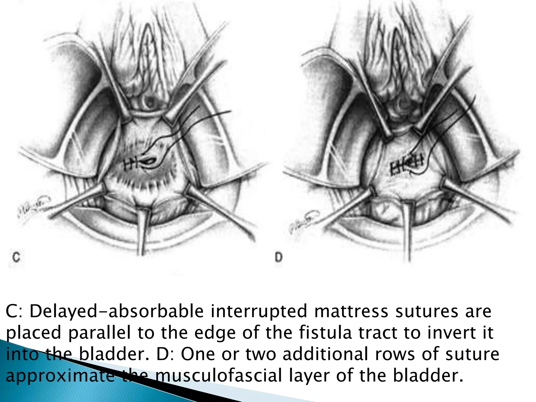 Vesico vaginal fistula | PPTX