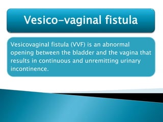 Vesicovaginal Fistula