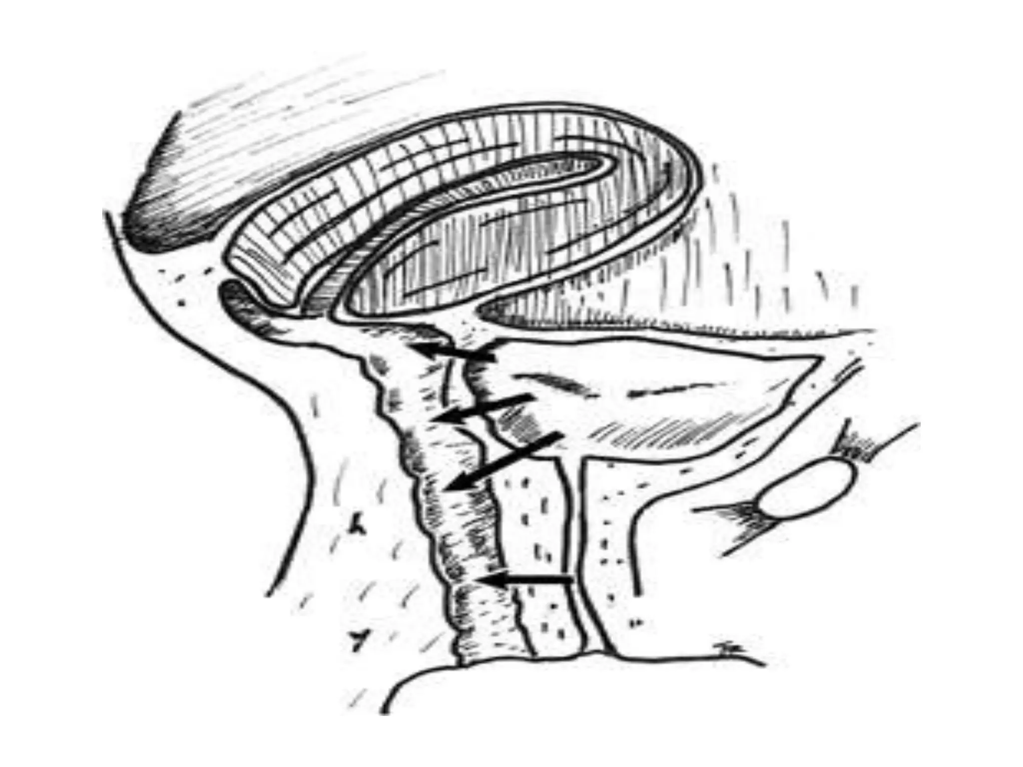 Vesico vaginal fistula | PPTX