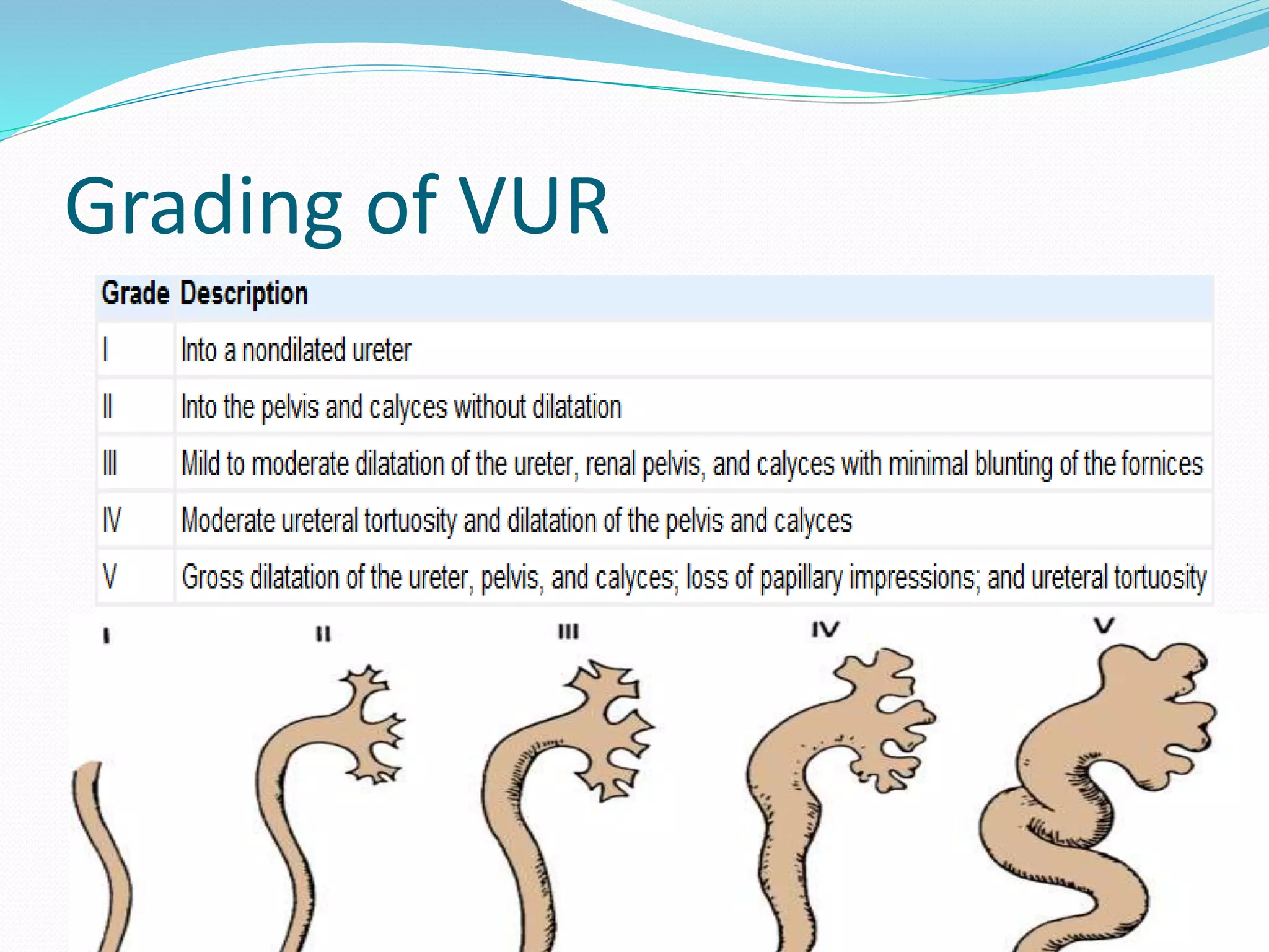 Vesicoureteral reflux | PPTX