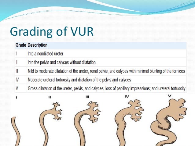Vesicoureteral reflux