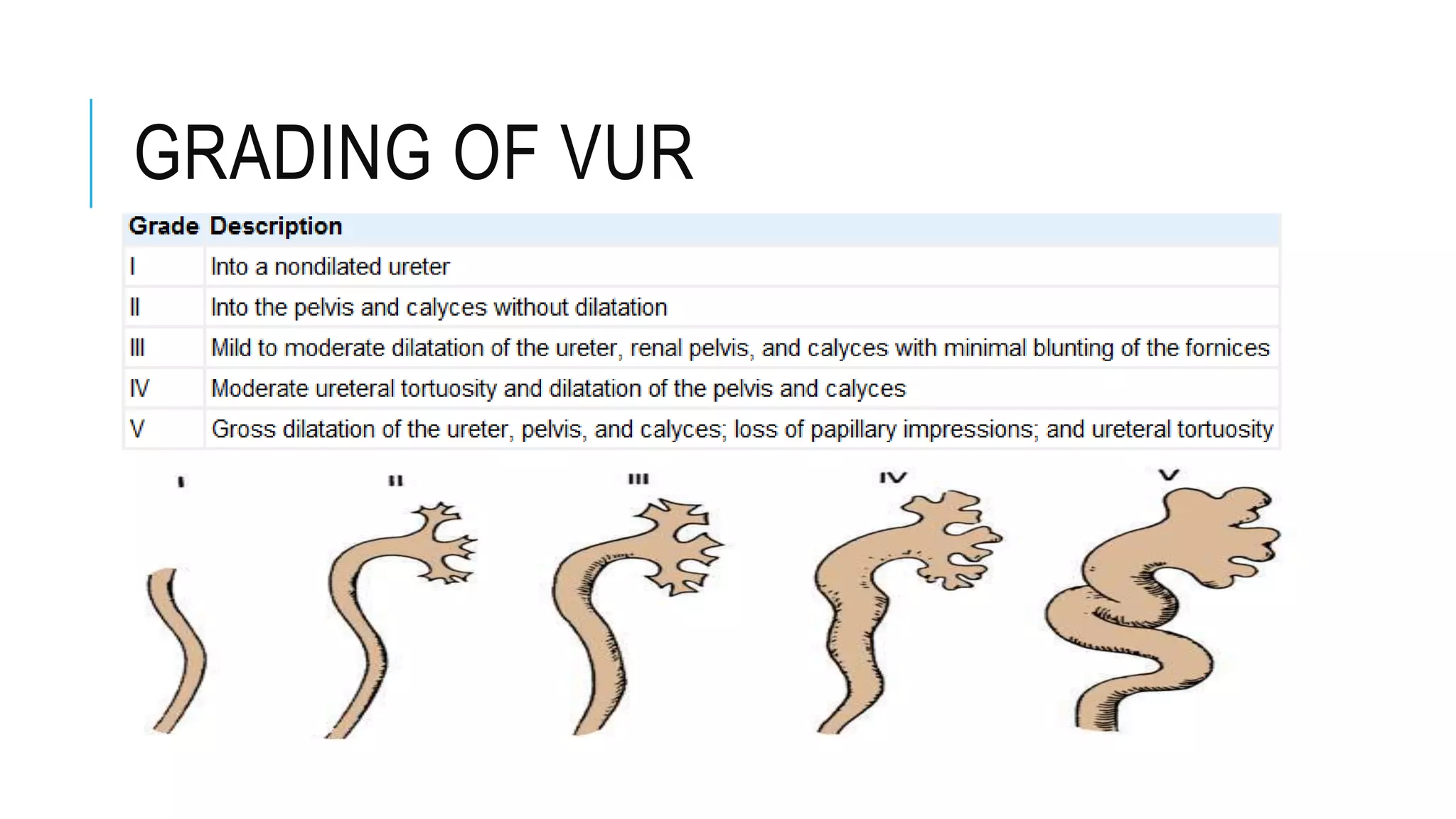 Vesicoureteral reflux | PPTX