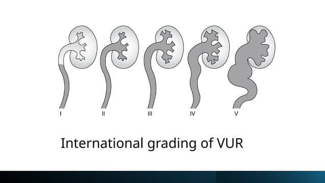 Vesicoureteral Reflux: Causes, Diagnosis, and Management | PPTX