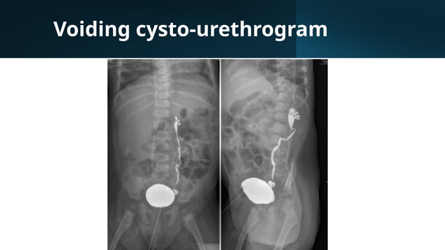 Vesicoureteral Reflux: Causes, Diagnosis, and Management | PPTX