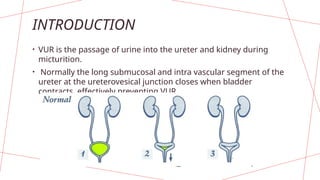 Vesicoureteral Reflux: Causes, Diagnosis, and Management | PPT