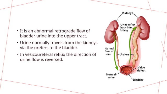 Vesicoureteral Reflux: Causes, Diagnosis, and Management | PPTX