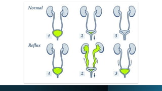 Vesicoureteral Reflux: Causes, Diagnosis, and Management | PPT