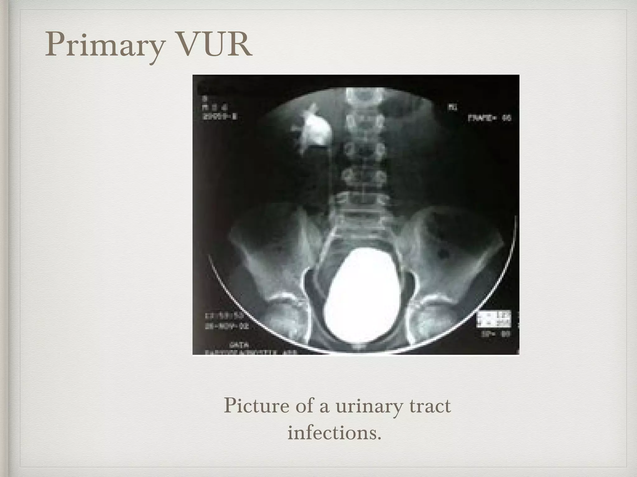Vesicoureteral reflux period 1 | PPT