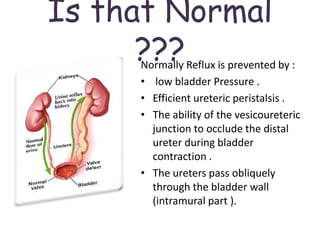 Vesicoureteral reflux ruwida | PPT