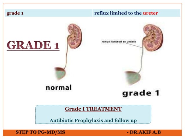 Vesico ureteric reflux | PPT