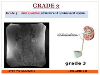 Vesico ureteric reflux | PPT