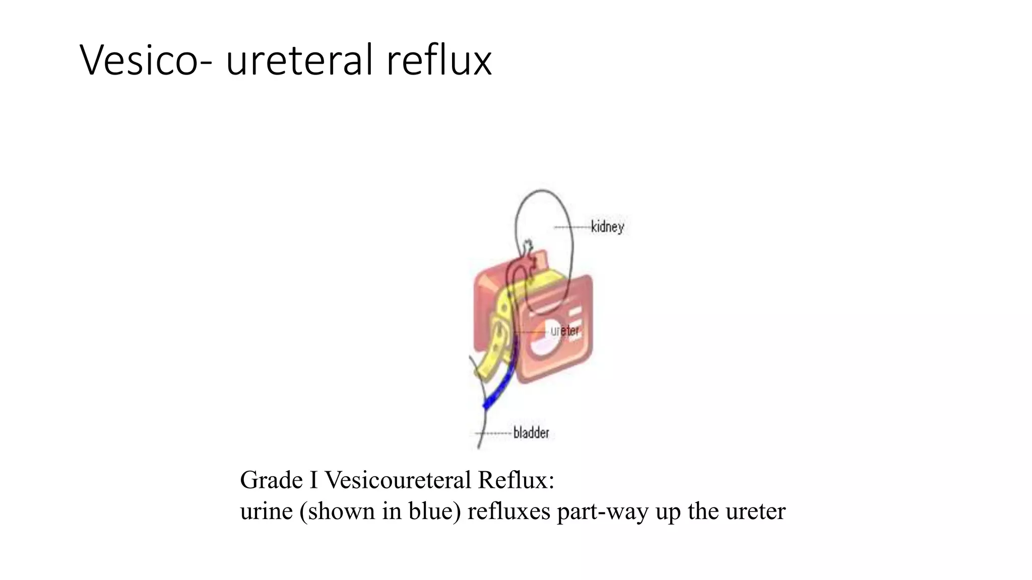 Vesicoureteric reflux by dr emmanuel, godwin | PPTX
