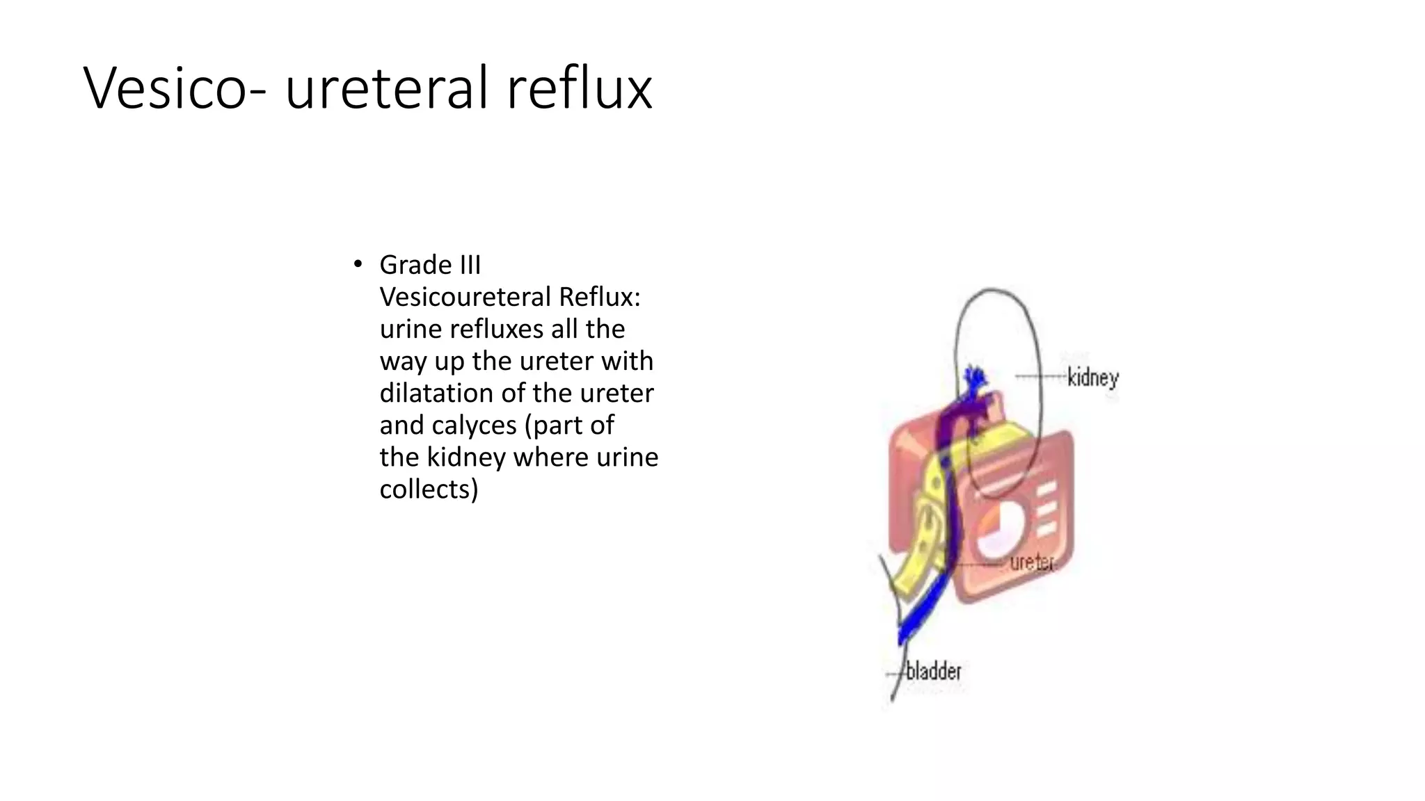 Vesicoureteric reflux by dr emmanuel, godwin | PPTX