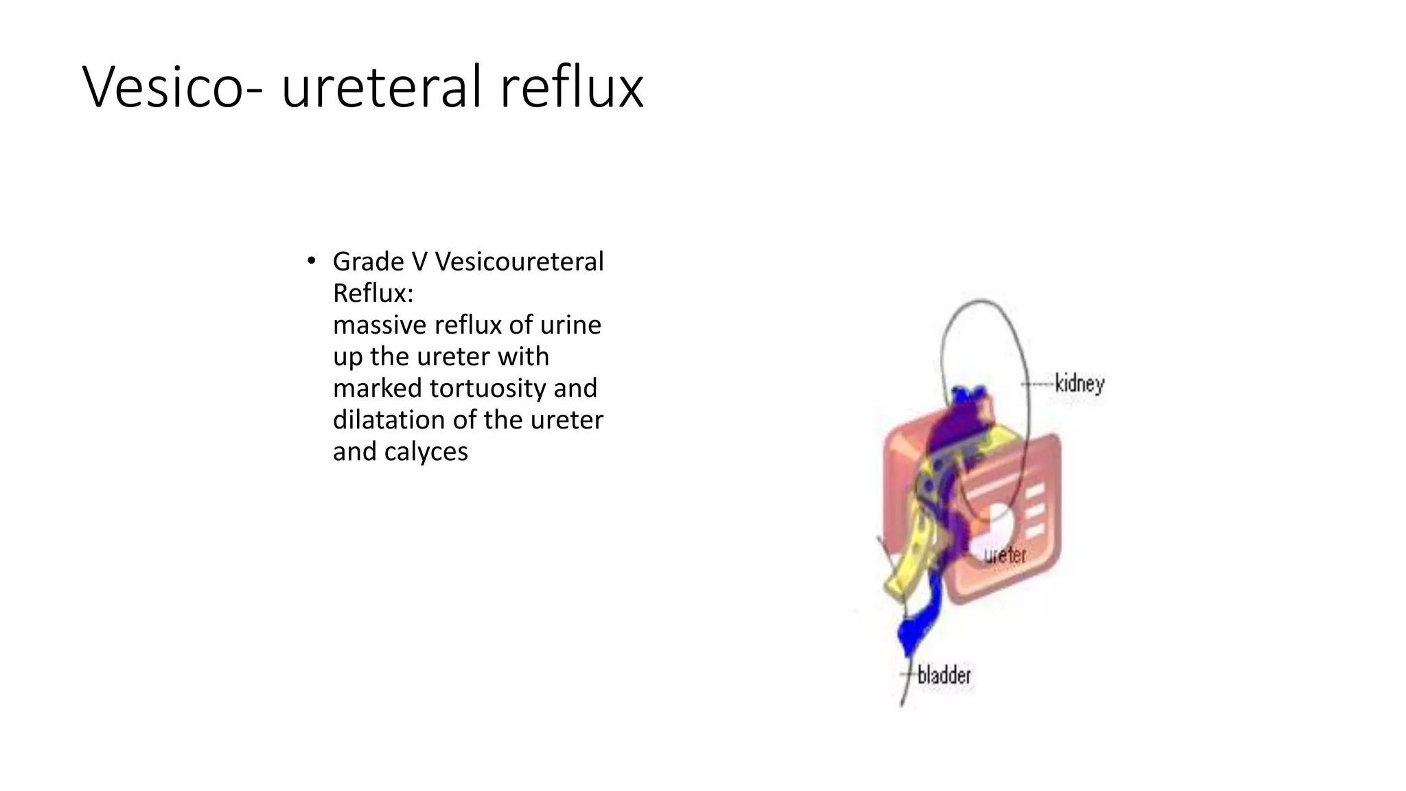 Vesicoureteric reflux by dr emmanuel, godwin | PPTX