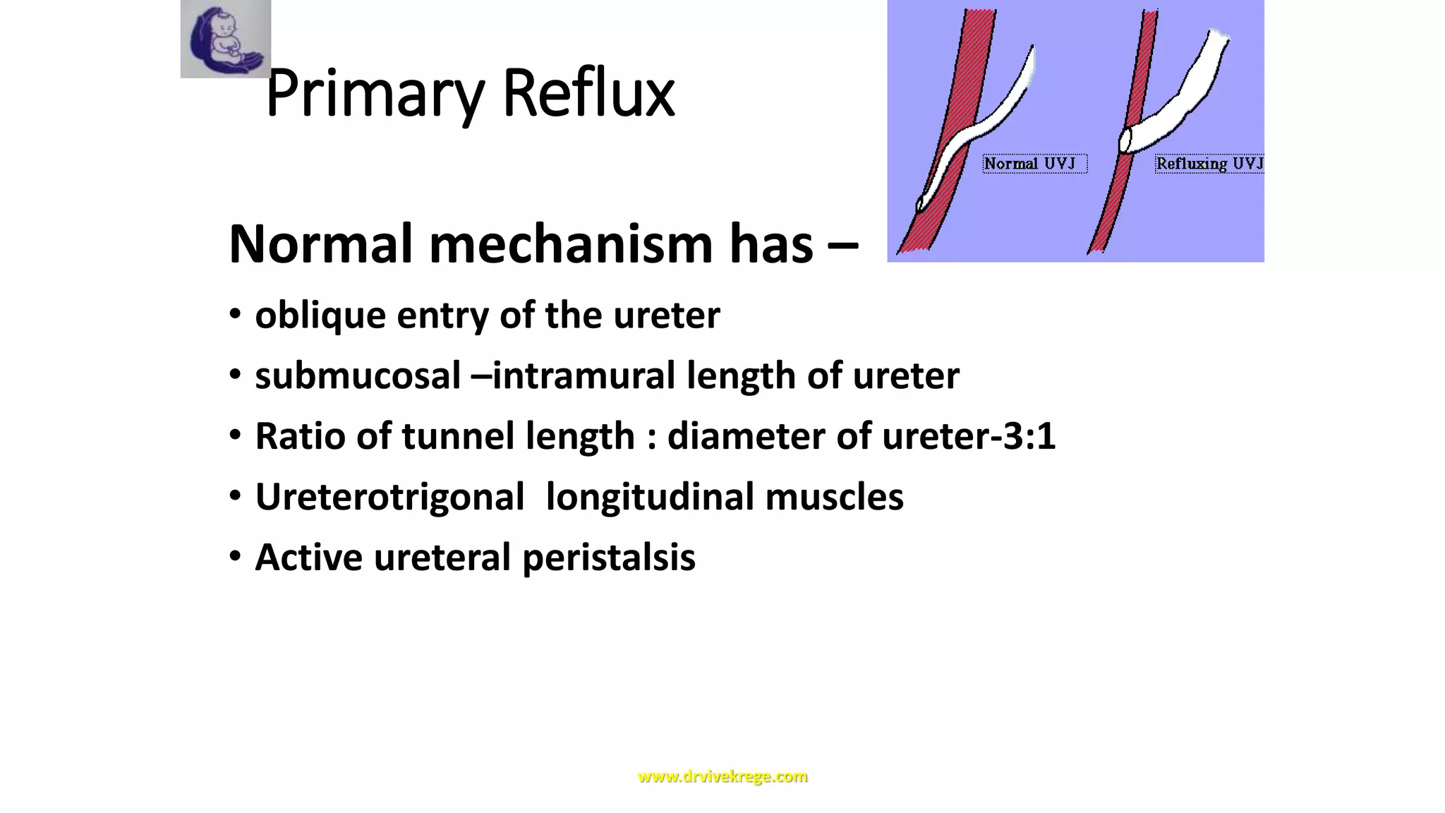 Vesicoureteric reflux by dr emmanuel, godwin | PPTX