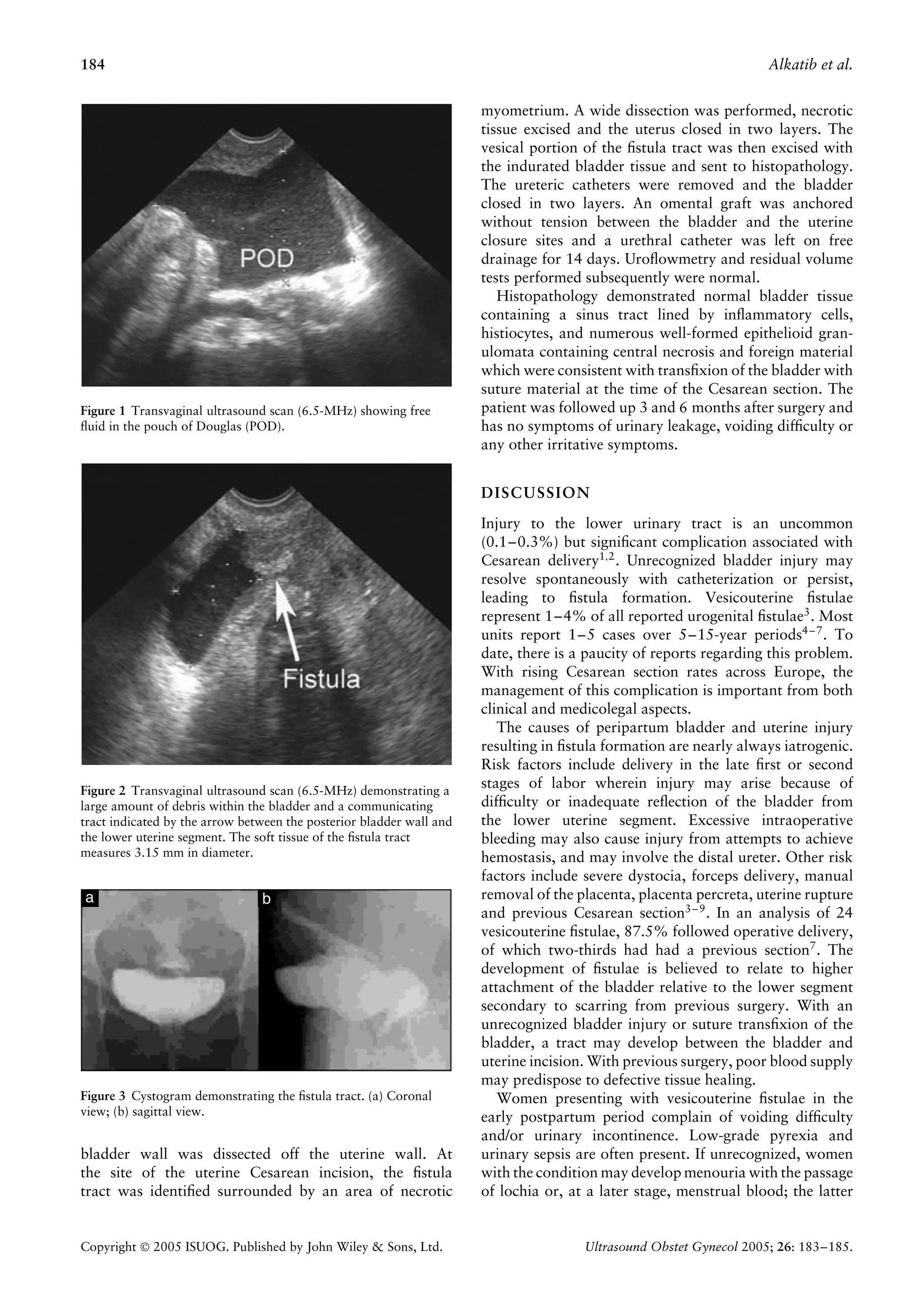 Vesicouterine Fistula Following Cesarean Delivery – Ultrasound ...
