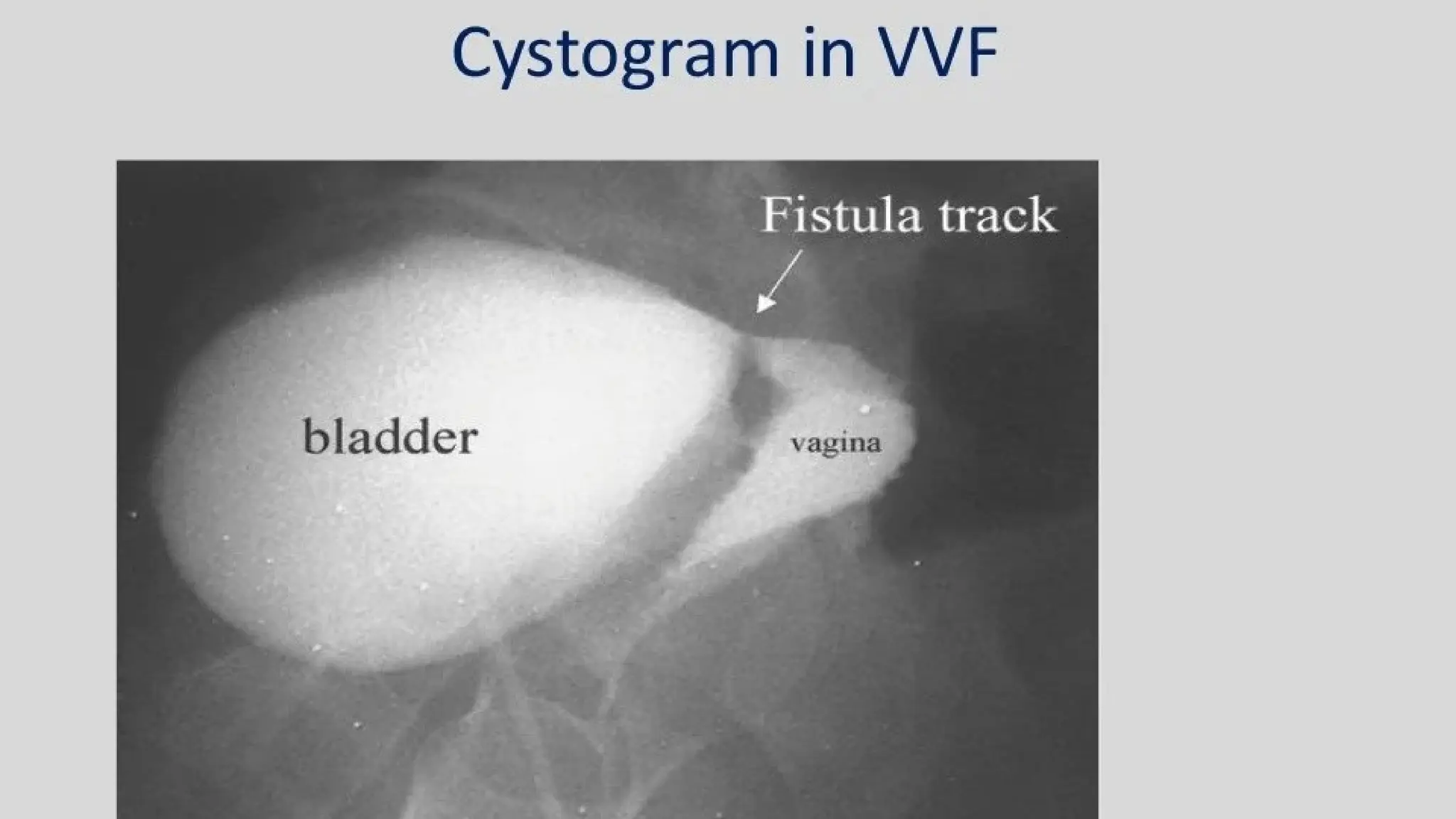 vesicovaginal fistula.pptx . | PPTX | Reproductive Health | Diseases ...