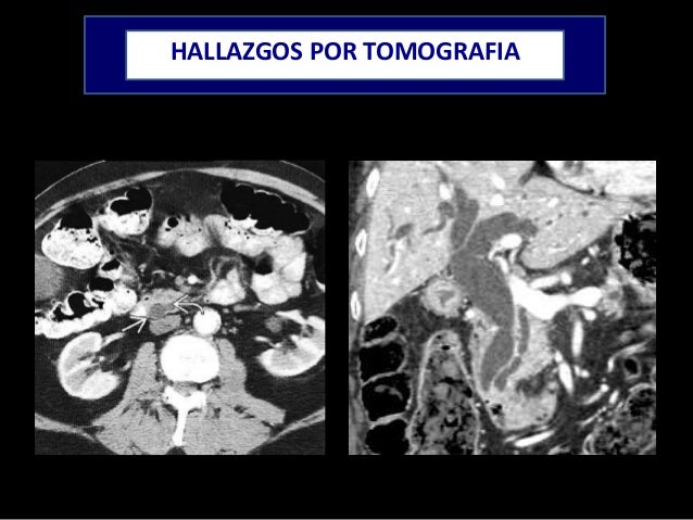 Patologia de la vesicula biliar y vias biliares hallazgos radiologi…