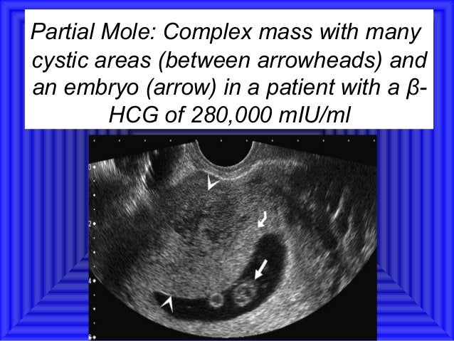 Vesicular mole for undergraduate