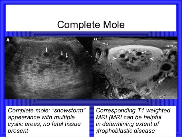 Vesicular mole for undergraduate