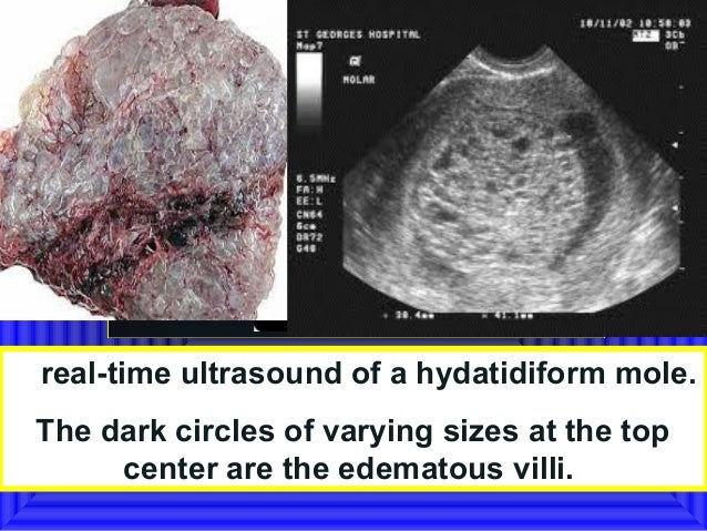 Vesicular mole for undergraduate