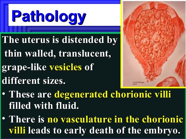 Vesicular mole for undergraduate