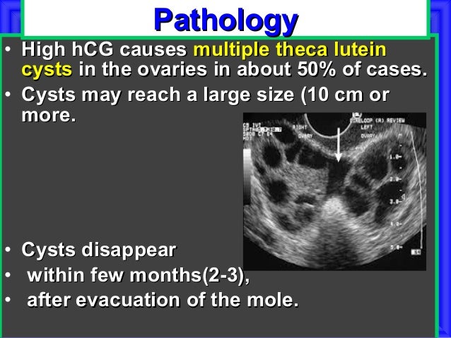 Vesicular mole for undergraduate