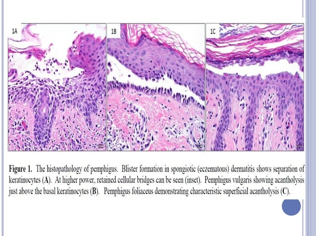 VESICULAR AND BULLOUS LESIONS OF SKIN (2).pptx | Skin and Dermatology ...