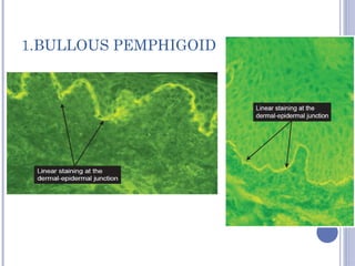 VESICULAR AND BULLOUS LESIONS OF SKIN (2).pptx