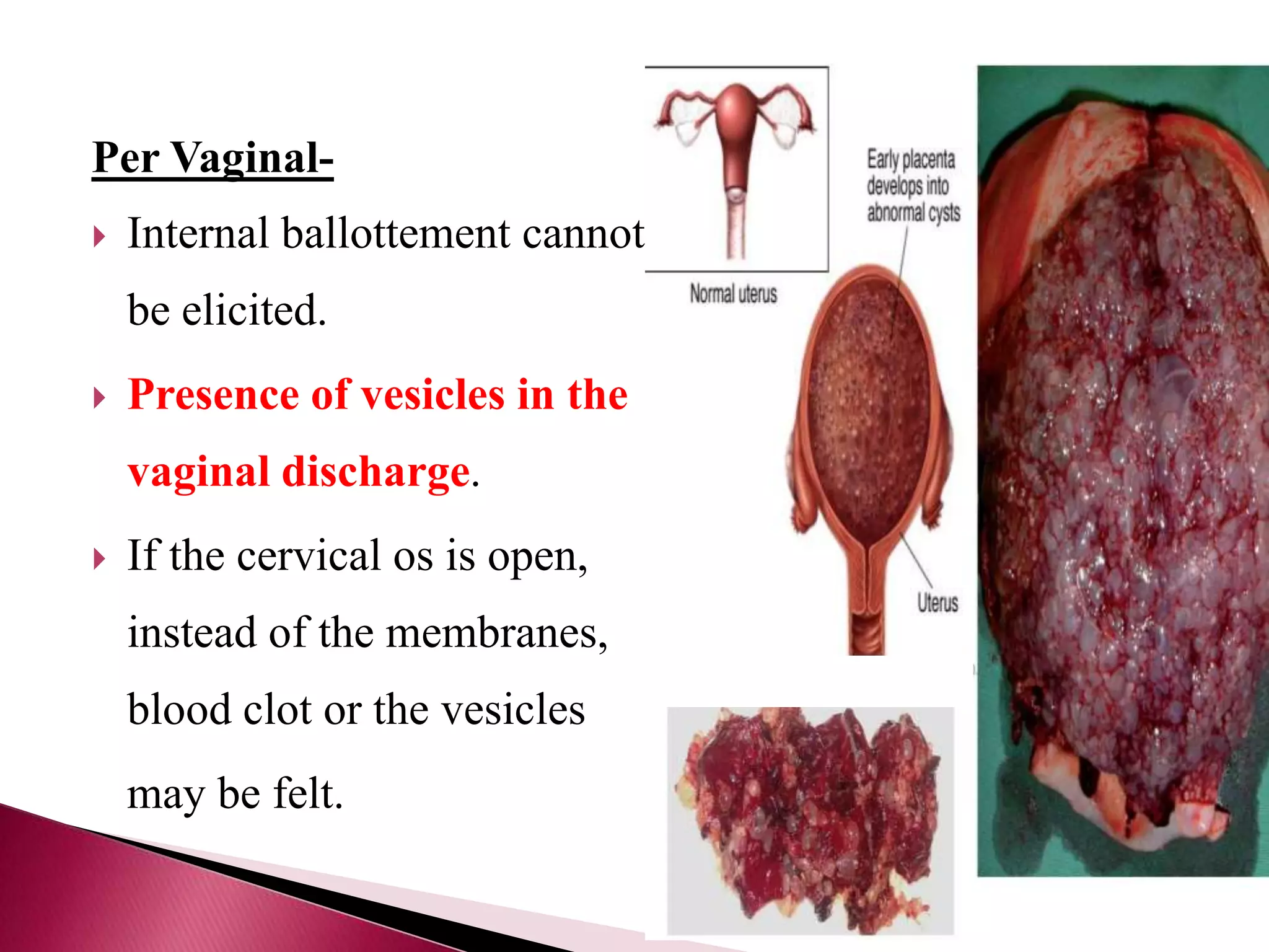 vesicular mole.pptx