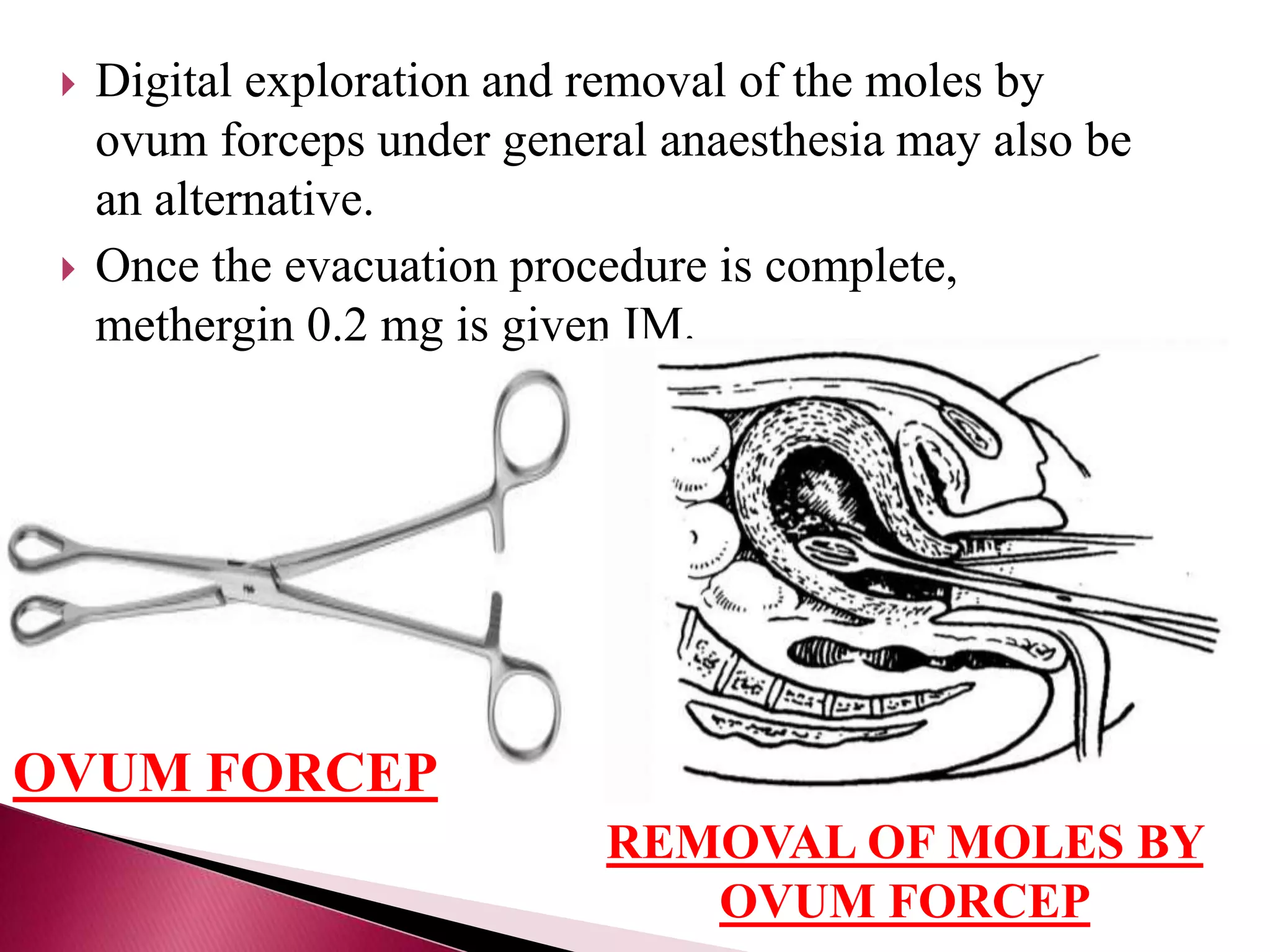 vesicular mole.pptx