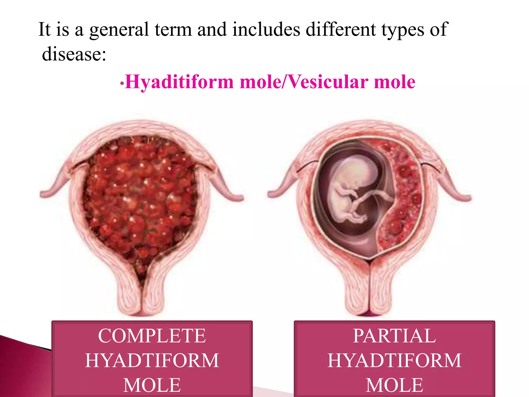 vesicular mole.pptx