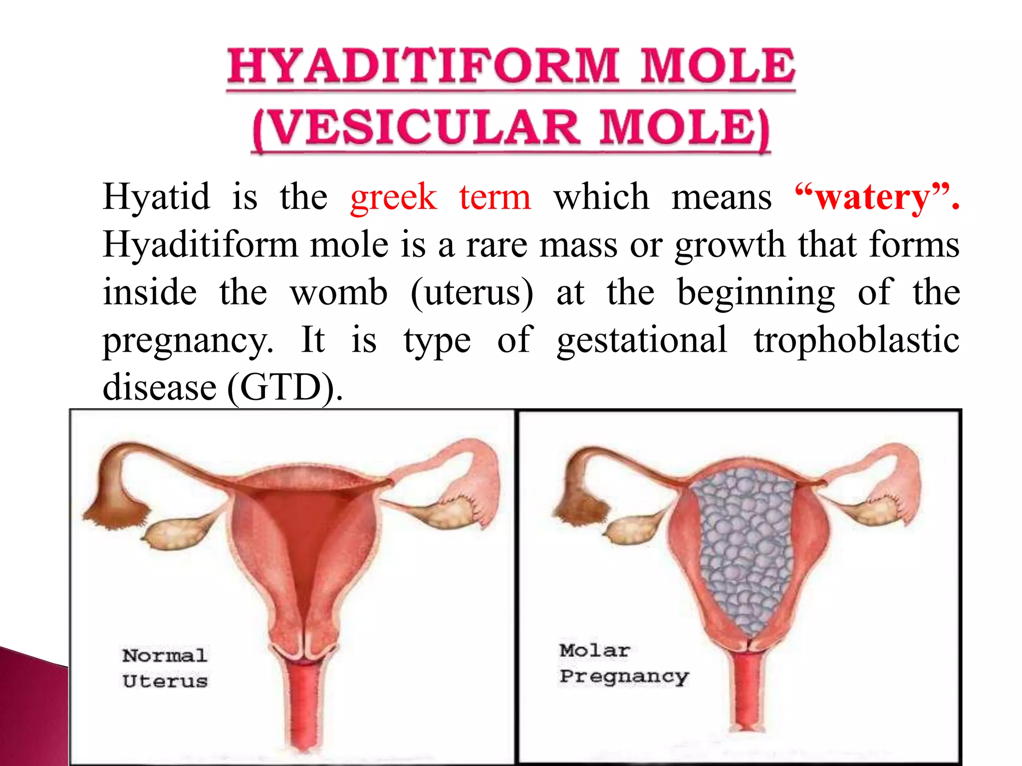 vesicular mole.pptx