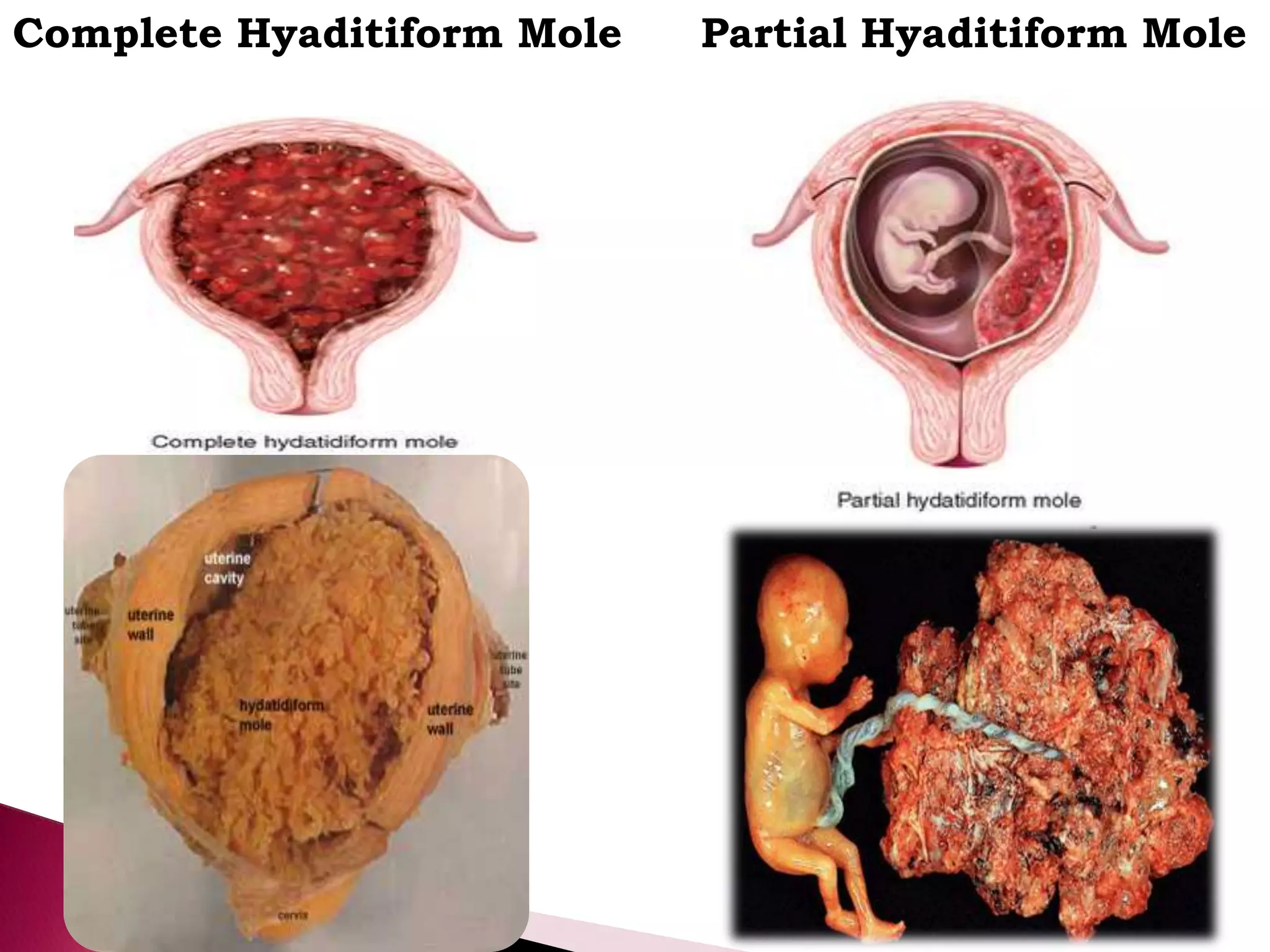 vesicular mole.pptx