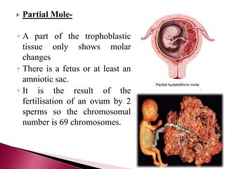 vesicular mole.pptx