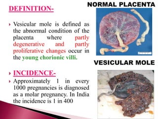 vesicular mole.pptx