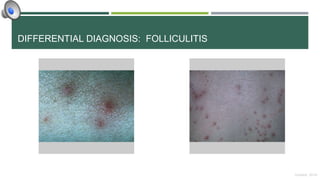 Case Presentation: Vesicular Rash | PPTX