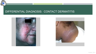 Case Presentation: Vesicular Rash | PPTX
