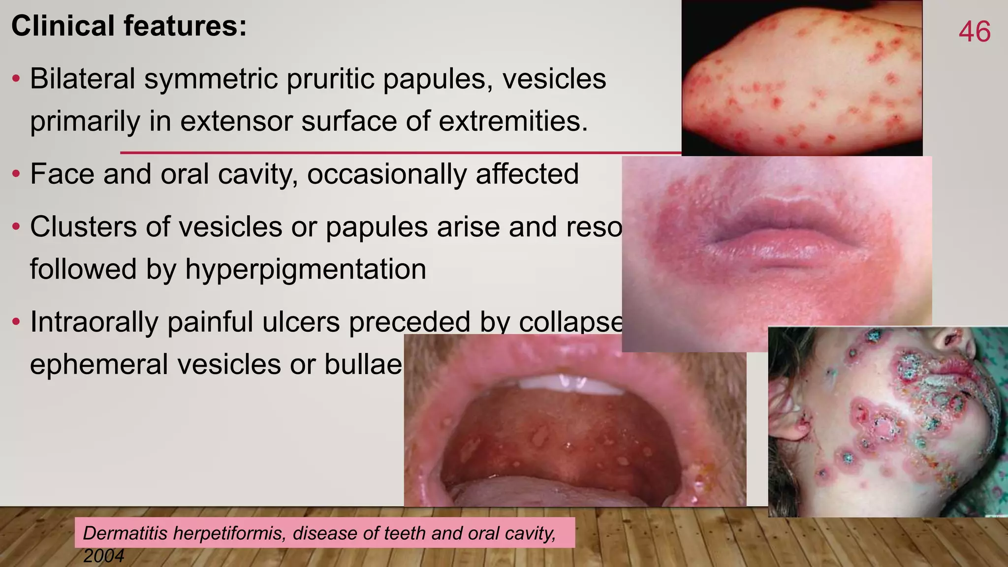 Vesiculo bullous lesions of oral cavity | PPTX