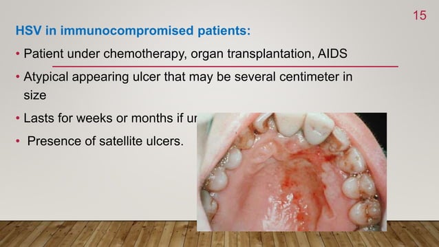 Vesiculo bullous lesions of oral cavity | PPTX | Infectious Diseases ...
