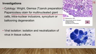 Vesiculo bullous lesions of oral cavity | PPTX
