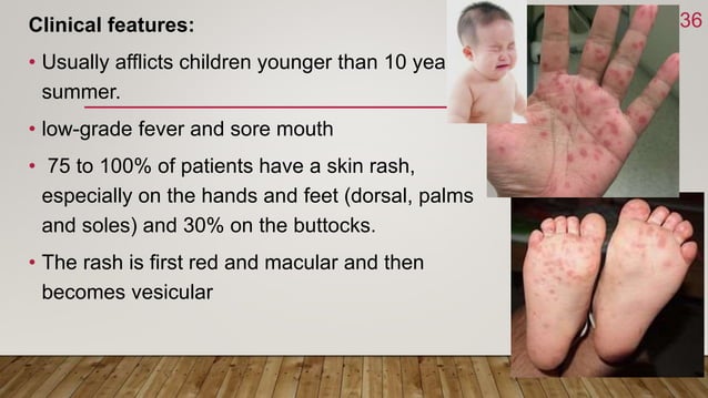 Vesiculo bullous lesions of oral cavity | PPTX | Infectious Diseases ...