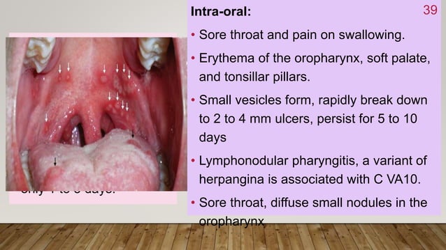 Vesiculo bullous lesions of oral cavity | PPTX | Infectious Diseases ...